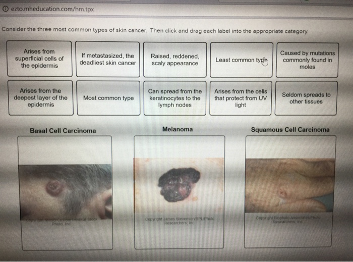 Solved Consider The Three Most Common Types Of Skin Cance