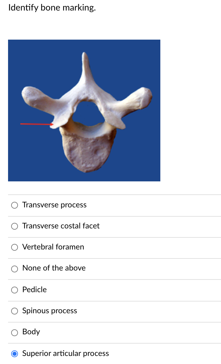 Solved Identify bone marking. O Posterior tubercle Lateral | Chegg.com