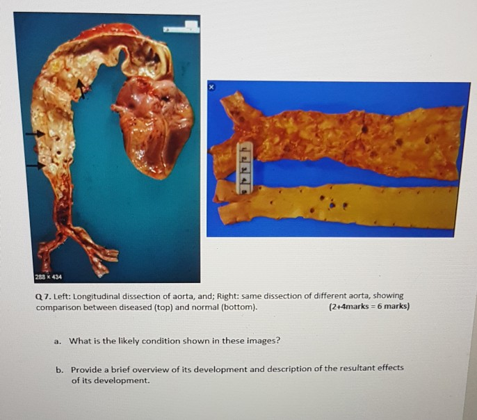 Solved 288 x 434 Q7. Left: Longitudinal dissection of aorta, | Chegg.com