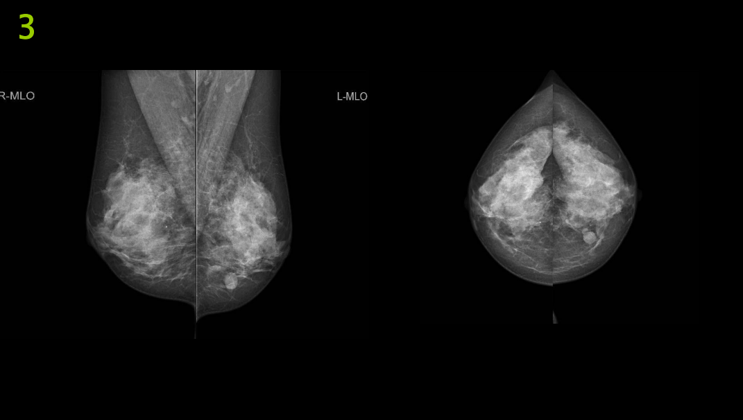 Mammography PGMI evaluation hi can i get help | Chegg.com