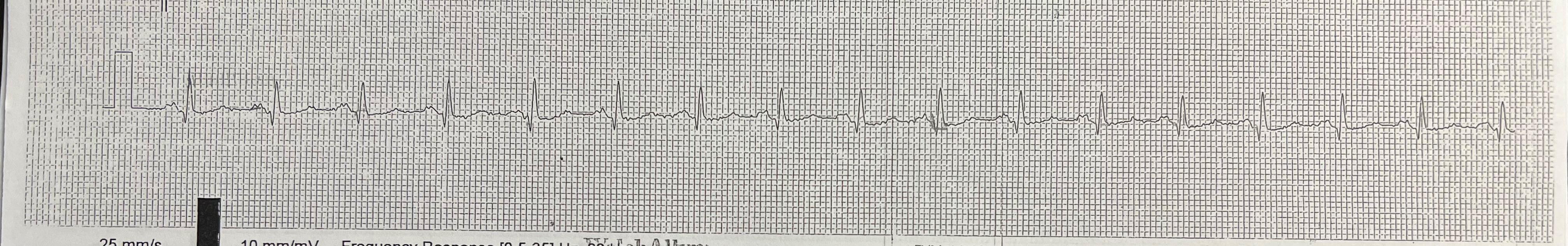 Solved ECG Interpretation: What is this ECG showing? This is | Chegg.com