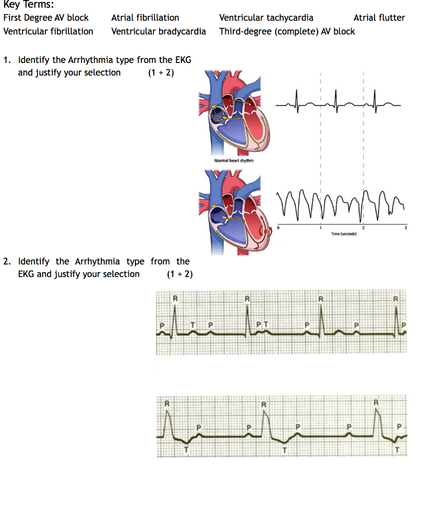 Ventricular Fibrillation Vs Atrial Fibrillation