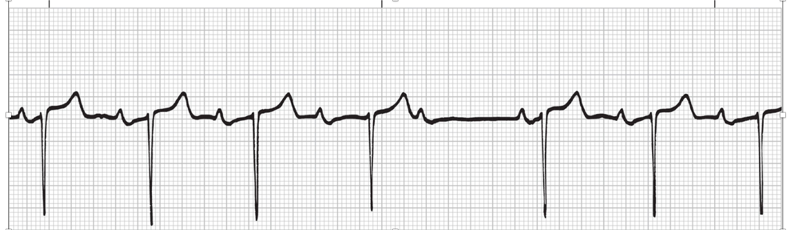 Solved is this a pace maker malfunction ecg rhtyhm | Chegg.com