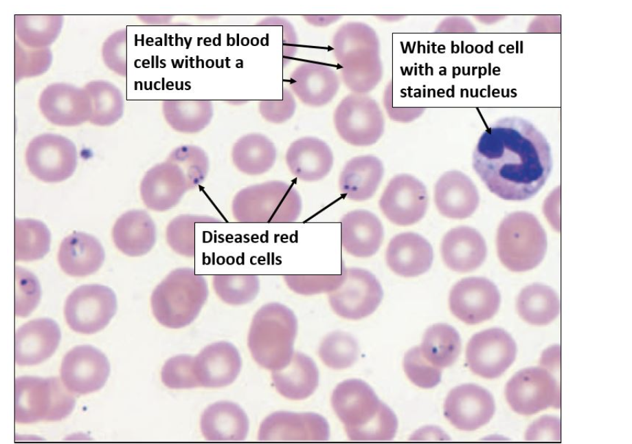 Solved Healthy red blood cells without a nucleus White blood | Chegg.com