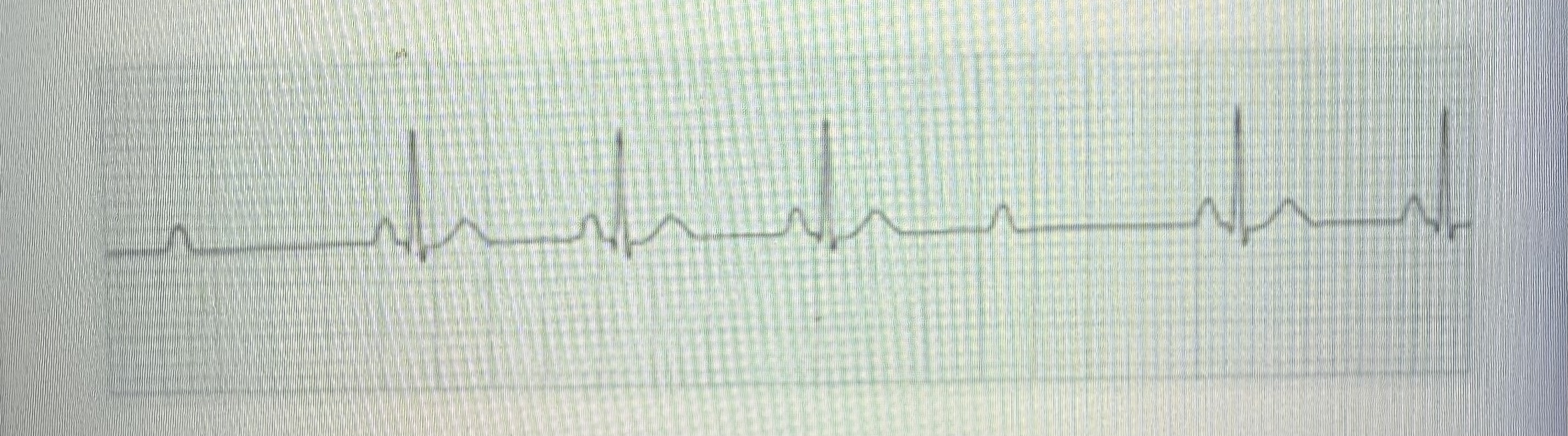 Solved by an EXPERT This ECG from lead II is an example of what:A ...