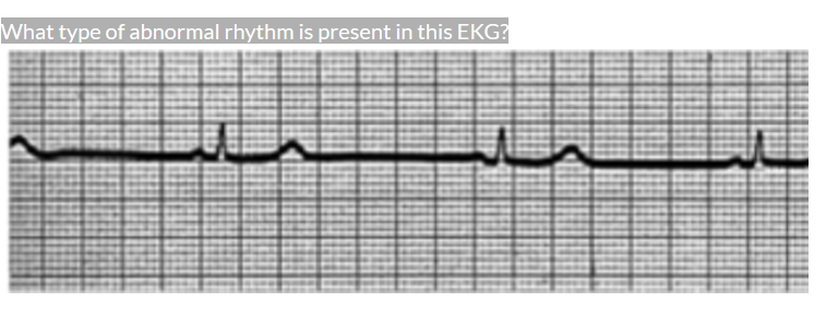 Solved What type of abnormal rhythm is present in this EKG? | Chegg.com