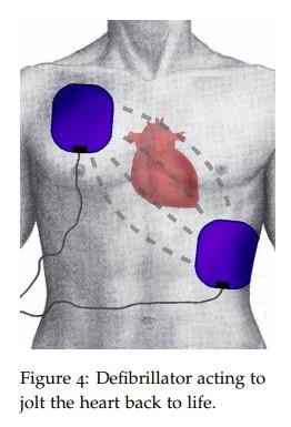 Solved A defibrillator is essentiallly a big capacitor. A | Chegg.com