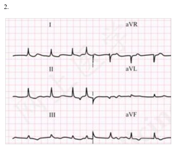 1. 2. 1 aVR III aVF | Chegg.com