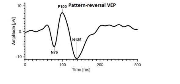 A typical pattern-reversal VEP is shown in figure. | Chegg.com