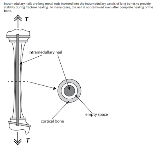 Solved Intramedullary nails are long metal rods inserted | Chegg.com