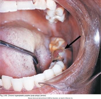 Chronic Hyperplastic Pulpitis