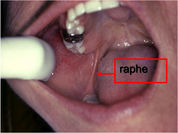 Pterygomandibular Raphe