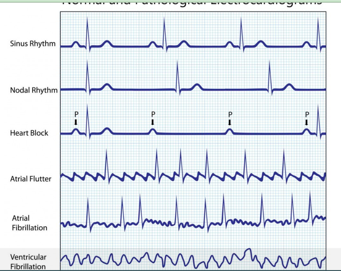 Solved ECG Readings What is visually different in the ECG | Chegg.com