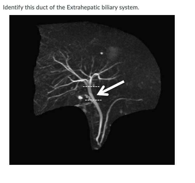 Solved Identify this duct of the Extrahepatic biliary | Chegg.com