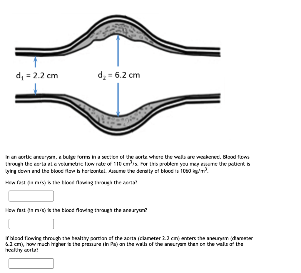 Solved di = 2.2 cm d2 = 6.2 cm In an aortic aneurysm, a | Chegg.com