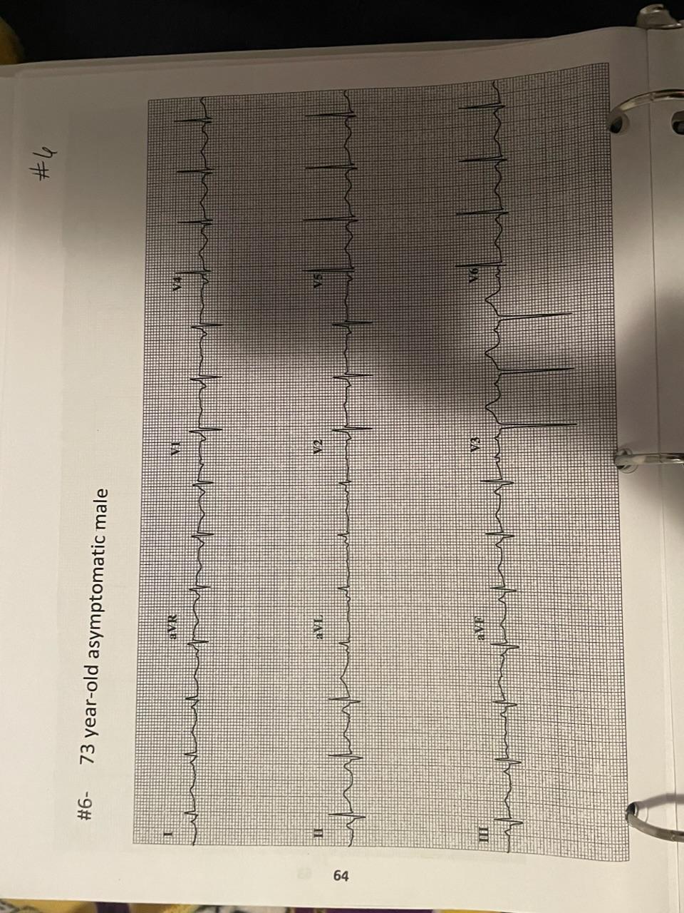 1. rhythm regular or irregular 2. determine the heart | Chegg.com