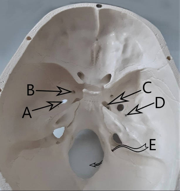Solved 1.The projection "A" is [ Select ] ["zygomatic | Chegg.com