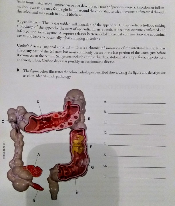 Solved The figure illustrates the colon pathologies | Chegg.com