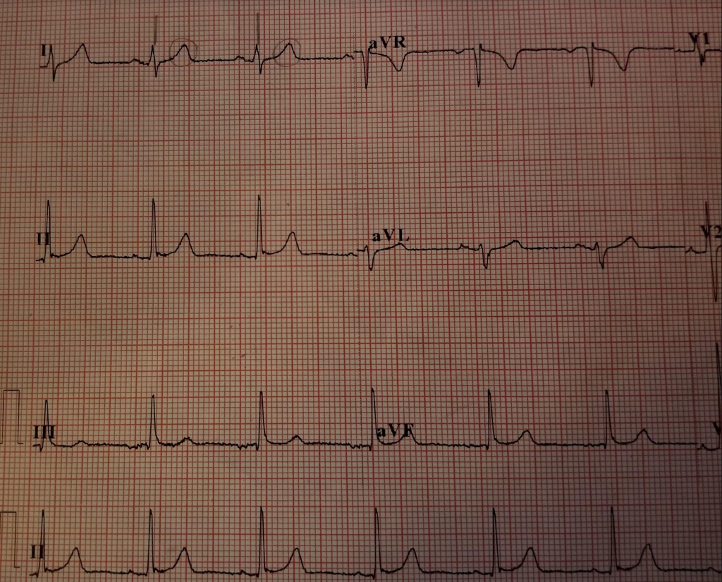 Solved Given Lead I-III, AVR, AVL, AVF, V1-V6 Rhythm | Chegg.com