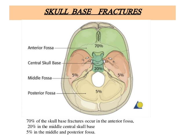 Anterior Fossa Fracture