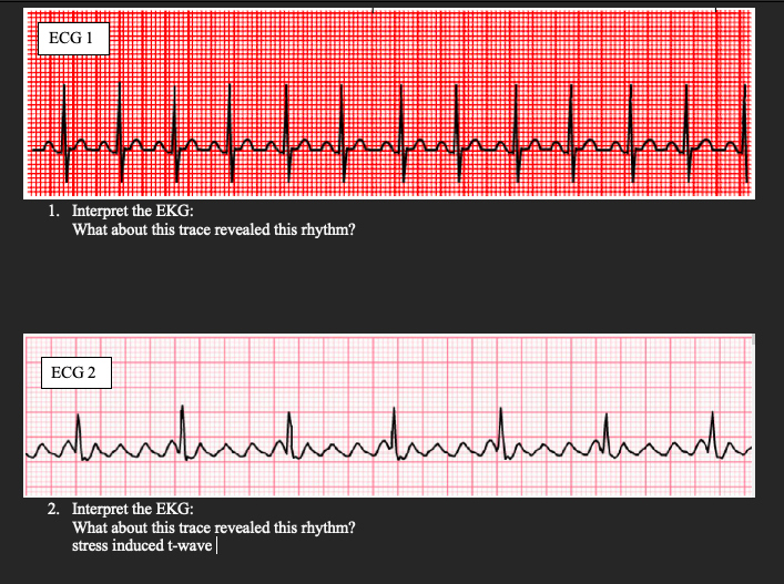 Solved ECG 1 WA ΑΑΑΑΑΑΑΑ m 1. Interpret the EKG: What about | Chegg.com