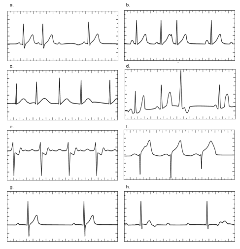Solved Analyzing the Heart with EKG Data analysis 1. | Chegg.com