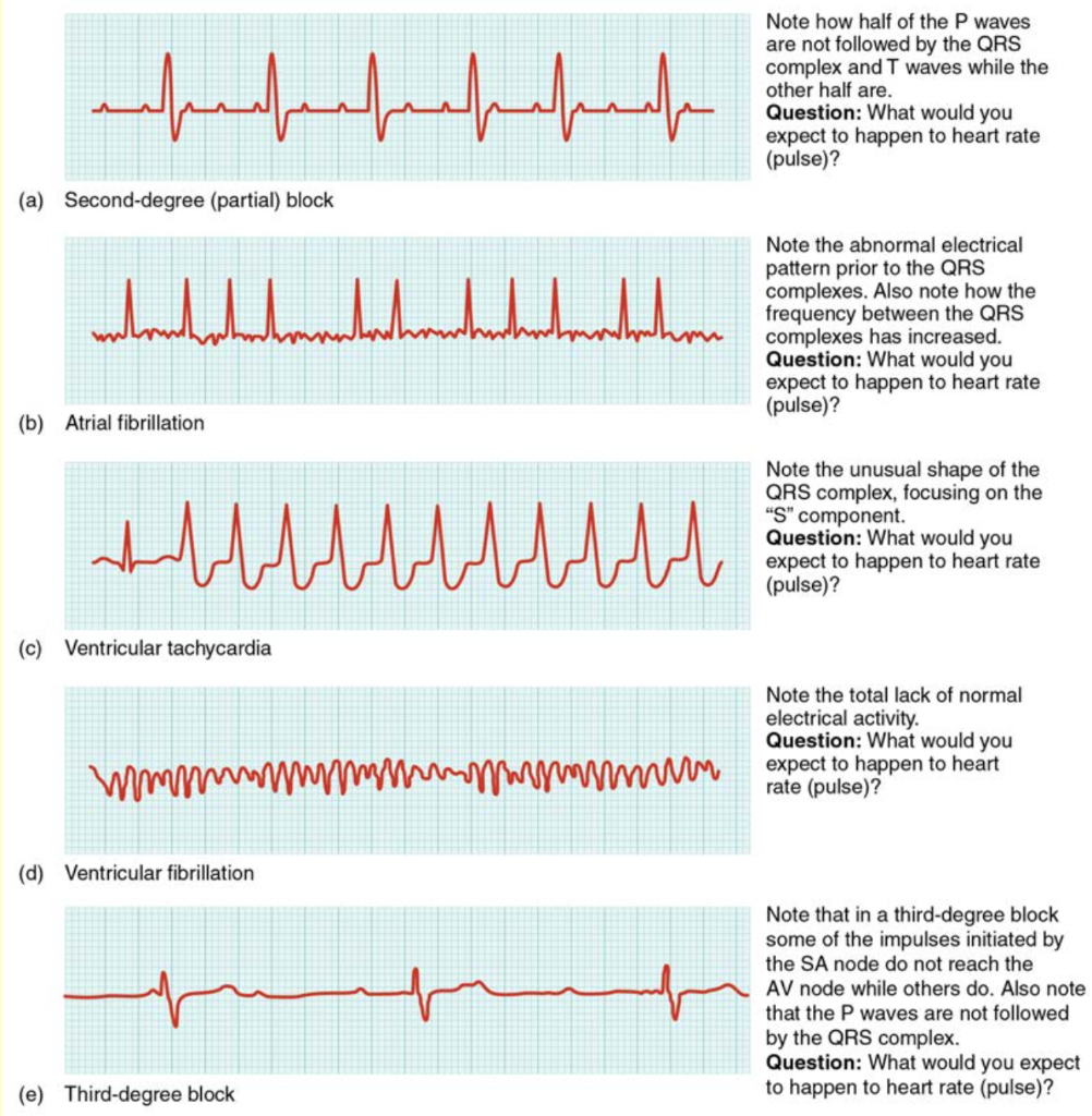 Killer ECG Patterns Part LITFL ECG Library 52 OFF Killer ECG Patterns Part LITFL ECG Library 52 OFF