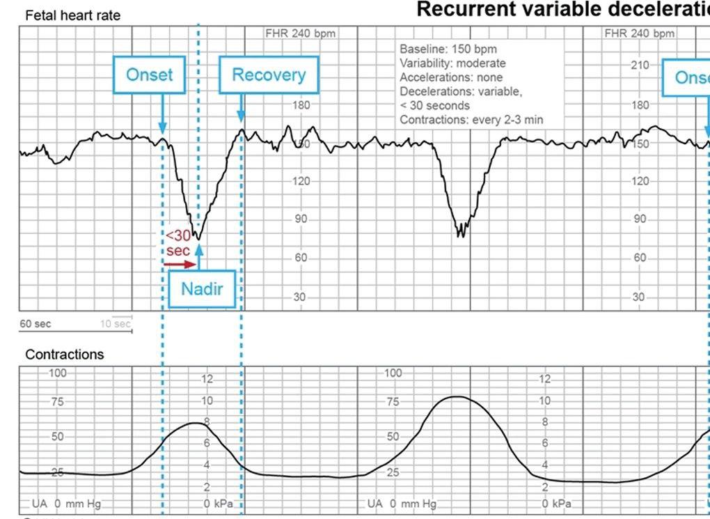 Solved Fetal heart rate Recurrent variable decelerati FHR | Chegg.com
