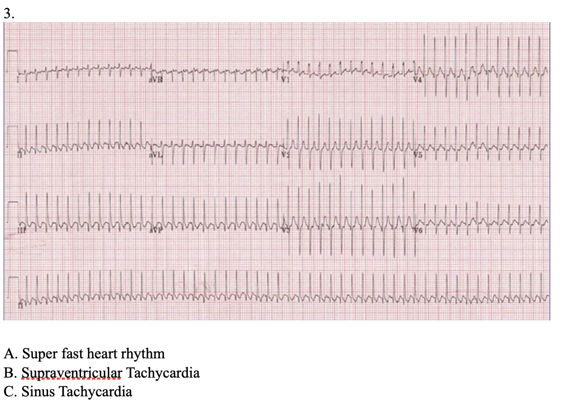 Solved A. Super fast heart rhythm B. Supraventricular | Chegg.com