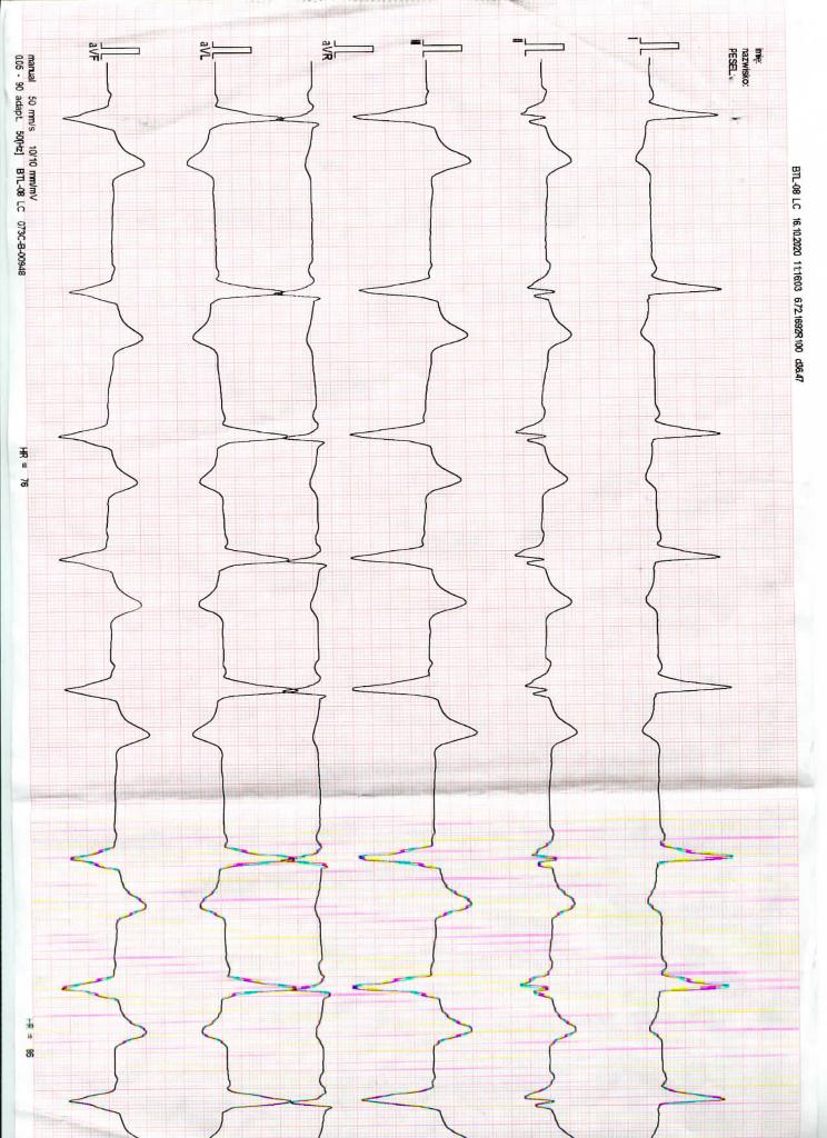 the patient 12 year old boy. Routine ECG performed | Chegg.com