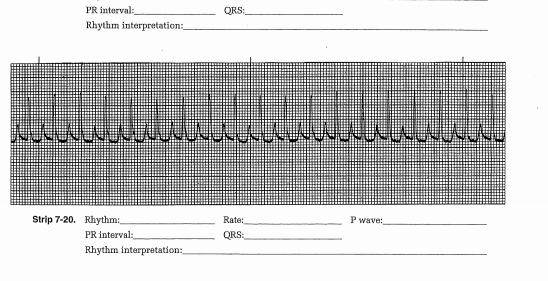 Solved Atrial Rhythm Packet 7.14 Rhythm: (regular or | Chegg.com