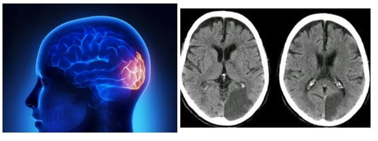 Solved Damage to specific regions of the cerebral cortex, | Chegg.com