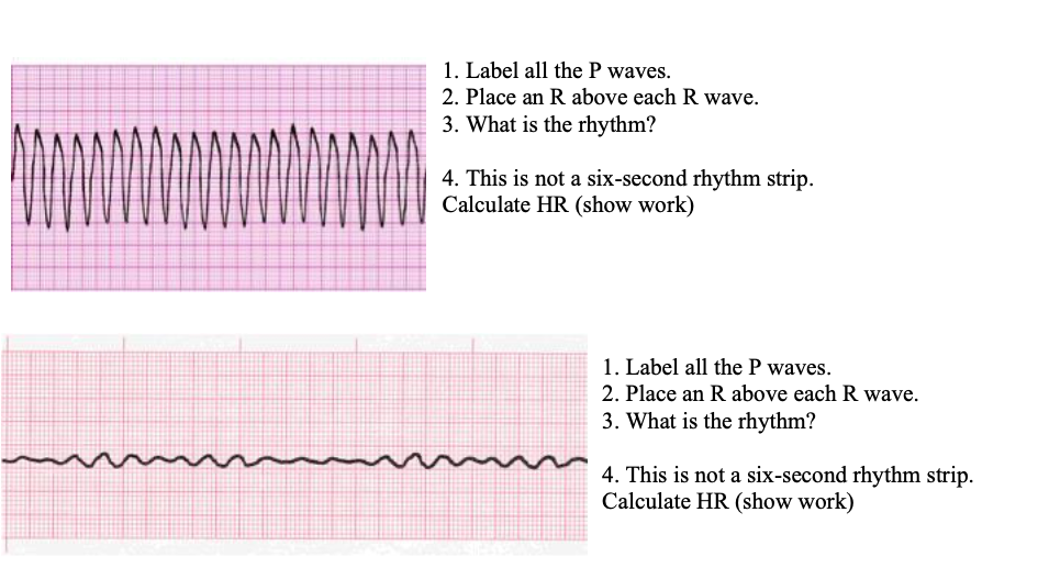 Solved Atrial fibrillation is a common heart rhythm | Chegg.com