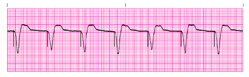 Wandering Atrial Pacemaker Rhythm Strip