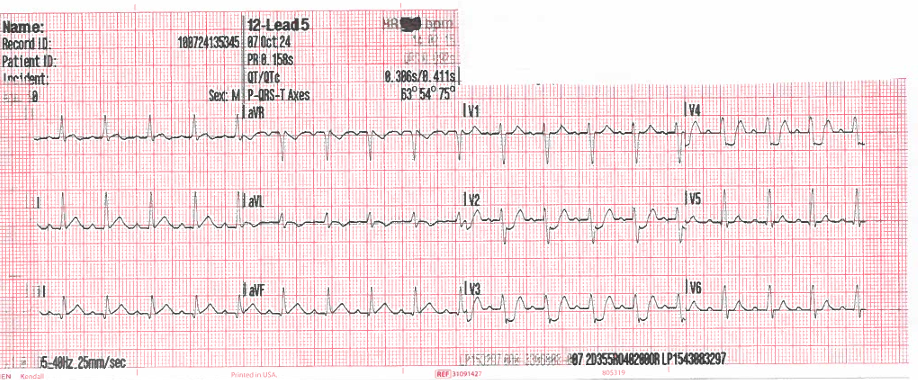 Solved I am needing to analyze 12 ﻿lead ECG strips and label | Chegg.com