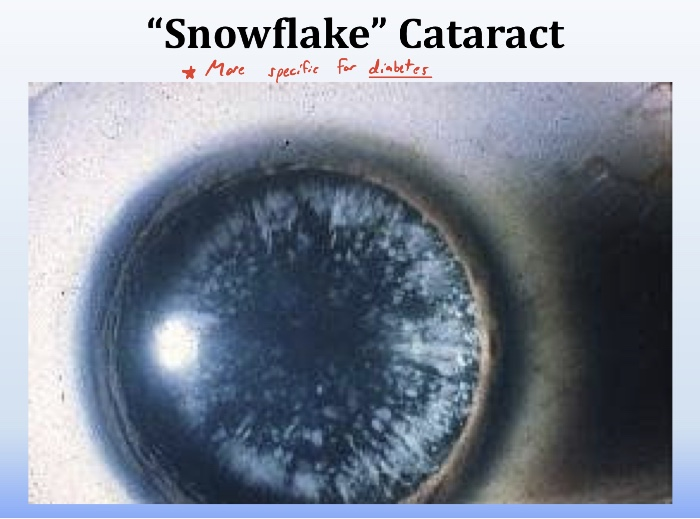 Snowflake Cataract