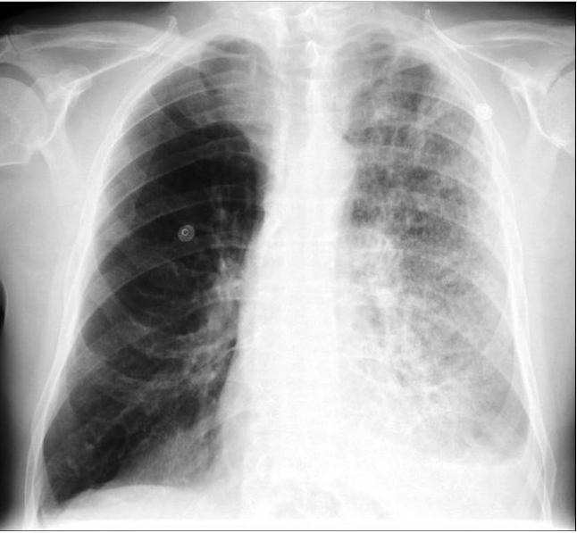 Solved 3- ﻿interpret this CXR and explain reasoning behind | Chegg.com