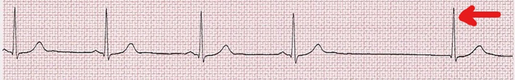 Solved What is the arrow pointing to in this EKG sinus beat | Chegg.com