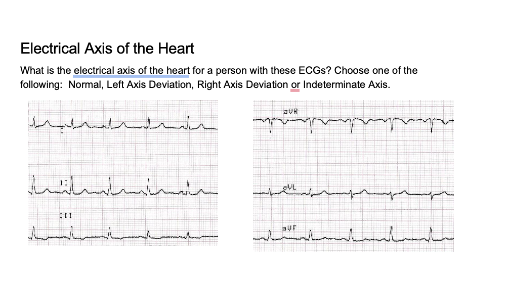 Solved Electrical Axis of the HeartWhat is the electrical | Chegg.com