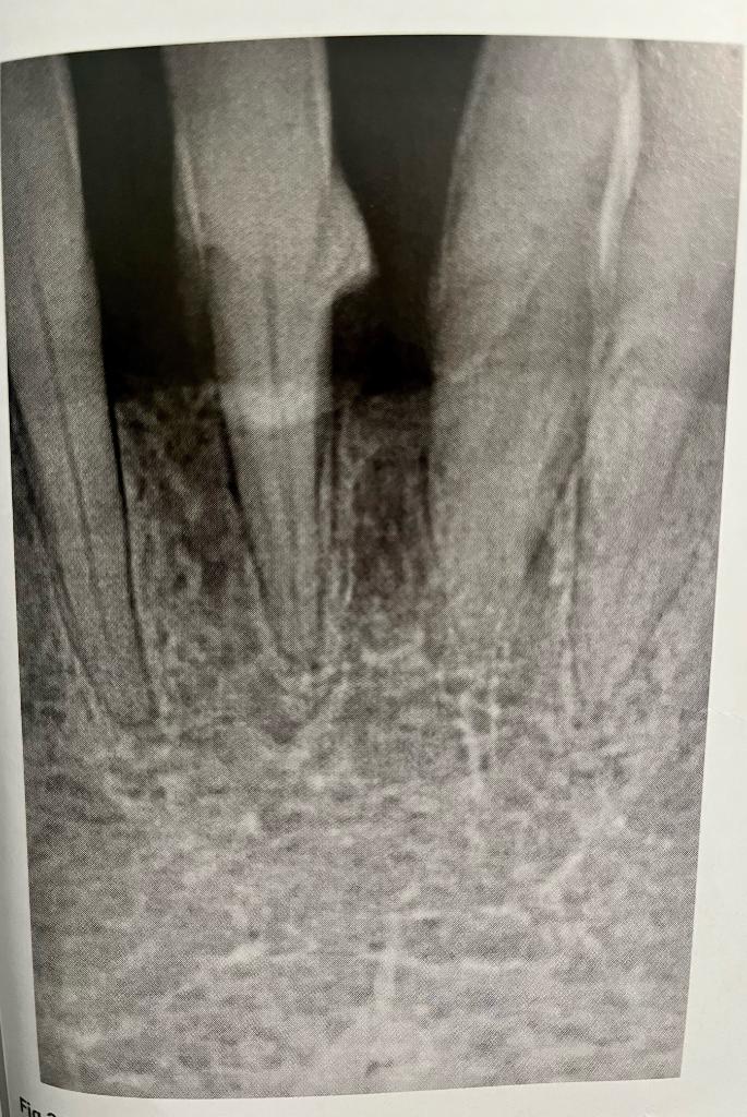 Identify the pattern of, severity of bone loss, and | Chegg.com