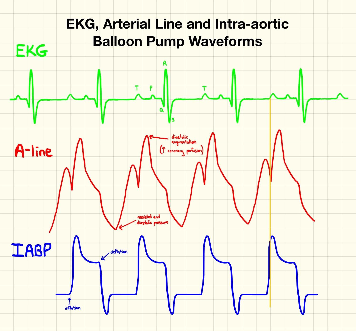 Intra Aortic Balloon Pump Waveform