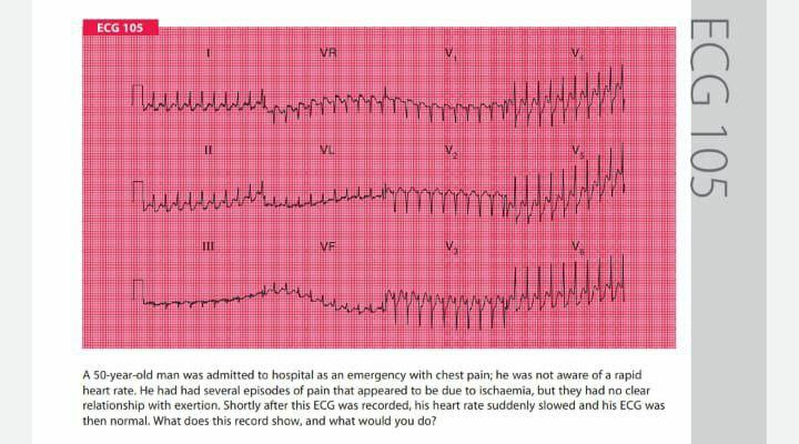 Solved ECG 105 VA Wwwdot promotion moyen ANA ECG 105 II VI V | Chegg.com