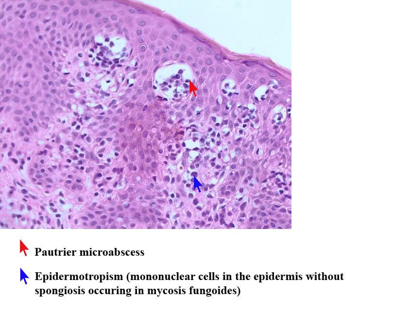 Pautrier Microabscesses Mycosis Fungoides