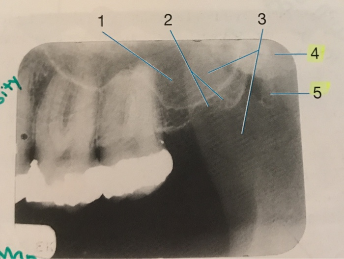 Zygomatic Process Of Maxilla Radiograph