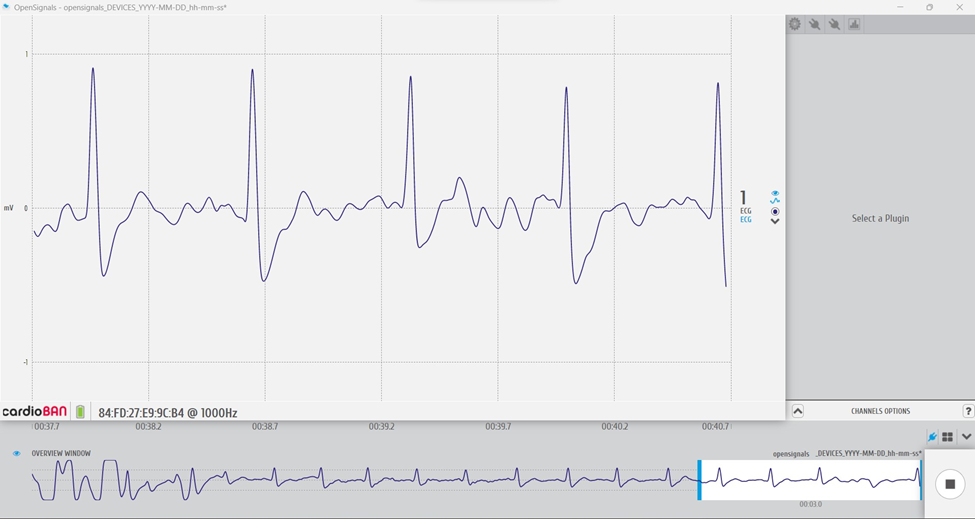 this is the ecg signal obatined in my assignment 2 | Chegg.com