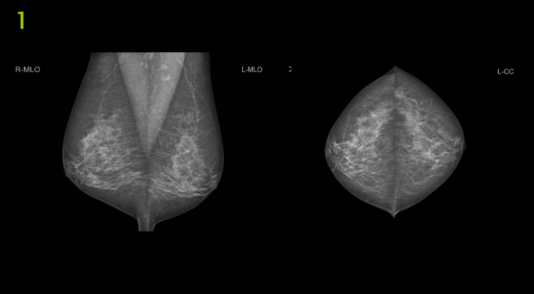 Mammography PGMI evaluation hi can i get help | Chegg.com