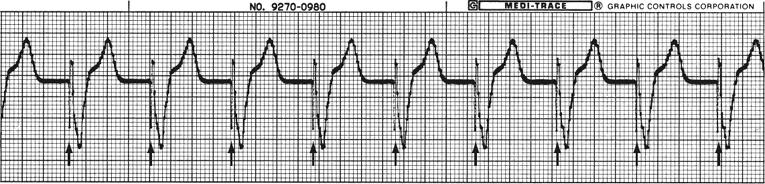 Solved Are the following pictures ECG pictures atrial or | Chegg.com