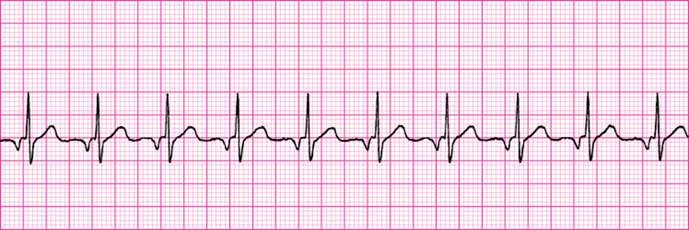 Solved what is this rythm? ﻿Atrial Fibrillation | Chegg.com