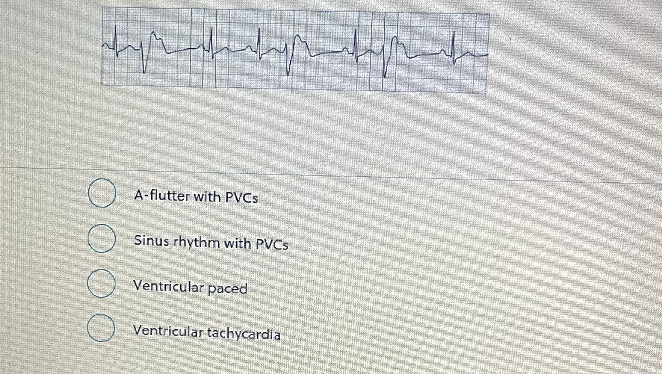 Solved A-flutter with PVCs Sinus rhythm with PVCs | Chegg.com