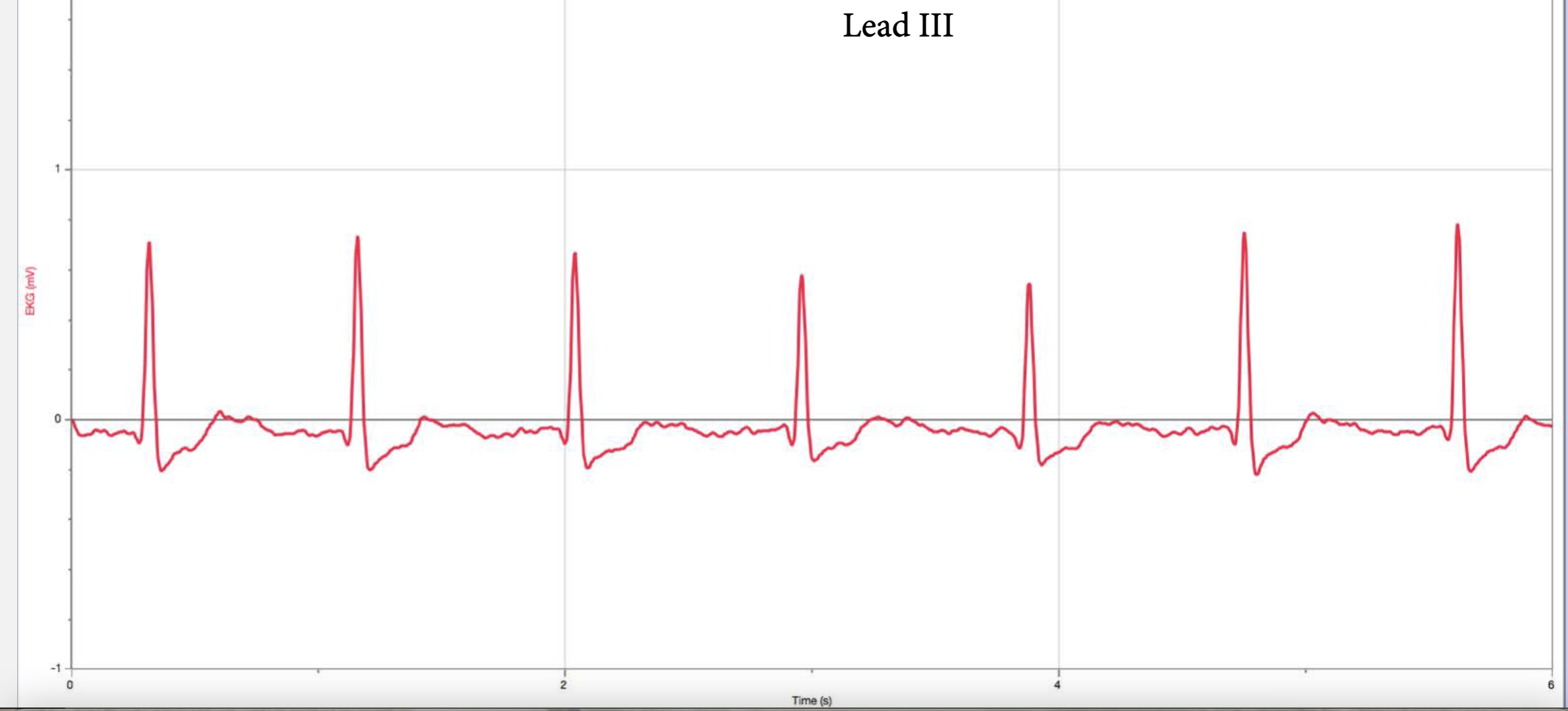 Solved Calculate the axis of a heart, or two, using EKG | Chegg.com